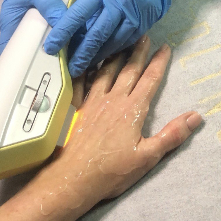 Фотоомоложение Кисти рук - BTL EXILITE - Headliners